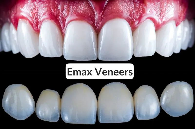Faseta E-max - Mula Dental Clinic